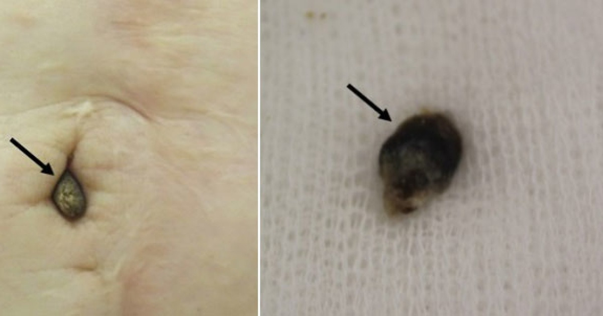 배꼽에서 꺼낸 까맣고 단단한 덩어리… 과연 '정체'가 뭘까?