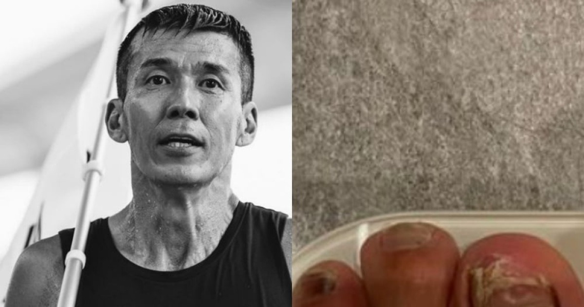 멀쩡한 발톱이 없네…션 "광복절 81.5km 러닝 후 4kg 빠져"