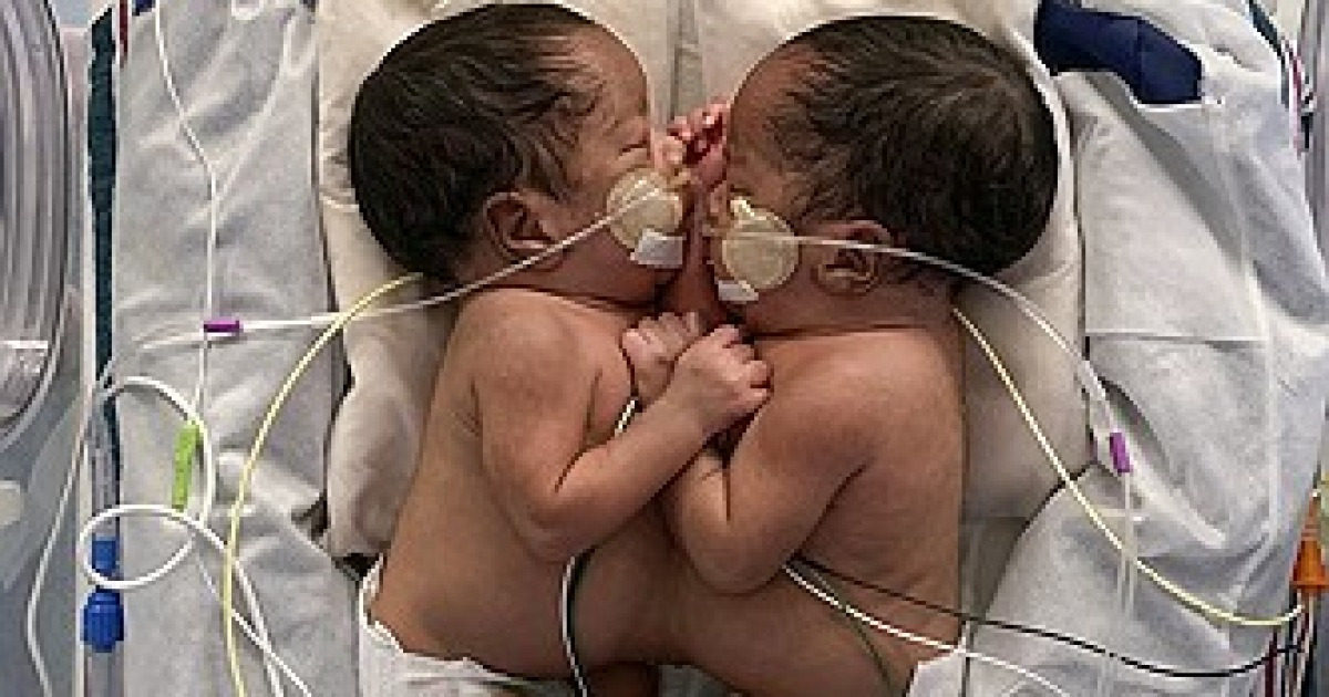 Conjoined Twins Separated