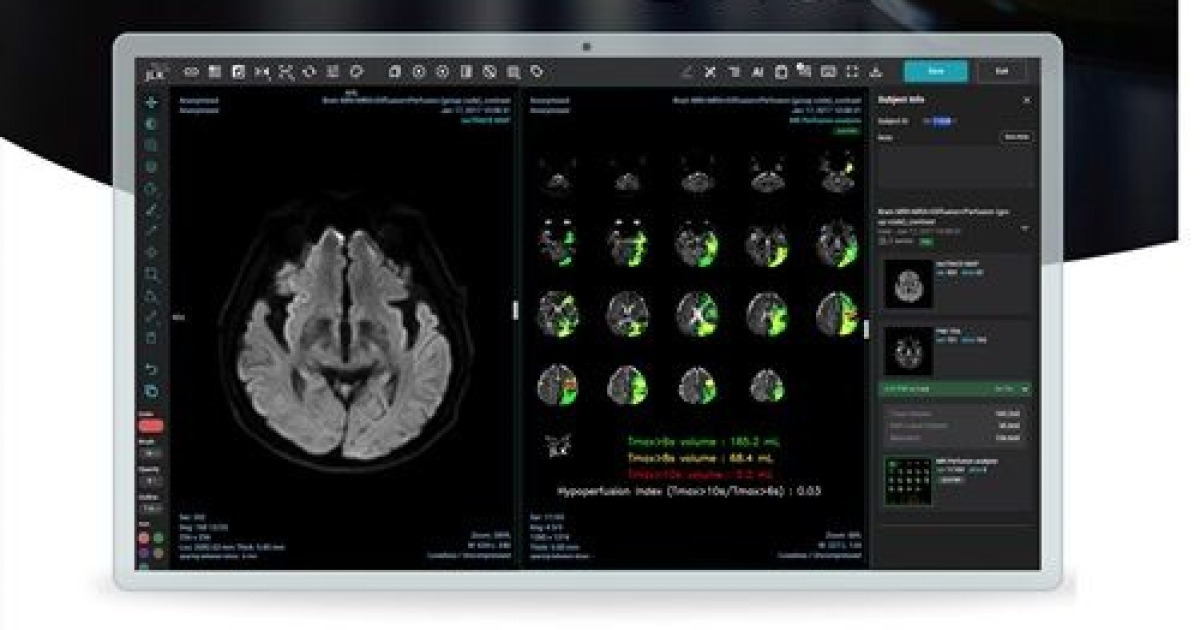 제이엘케이, 뇌 MR 관류영상 분석 JLK-PWI…네 번째 美FDA 승인
