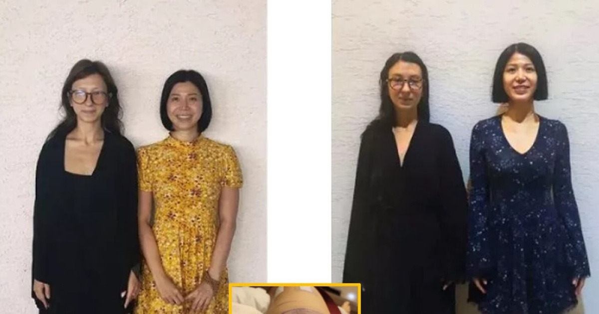 "157cm→165cm 키 커져"...5천만원에 다리 8cm 늘린 女, 어떤 수술?