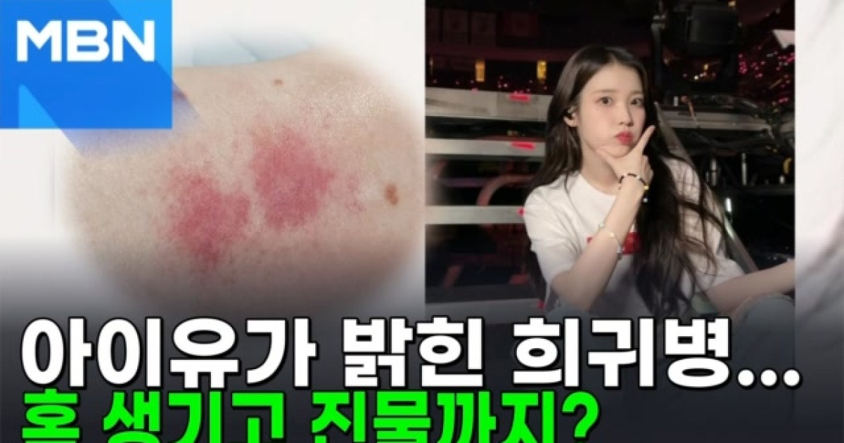 아이유가 앓는 희귀병…혹 생기고 진물 터지고 [ai 뉴스피드]