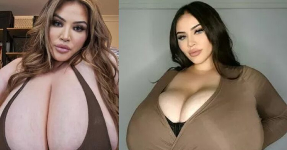 "유방 계속 커져 P컵 됐다"...가슴둘레만 143cm女 '이 병' 때문, 뭐길래?