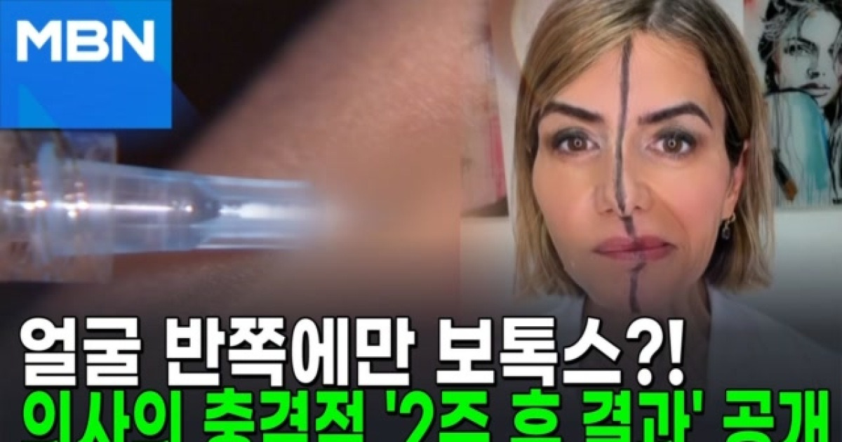 얼굴 반쪽에만 보톡스 실험…2주 후에 결과는? [AI뉴스피드]