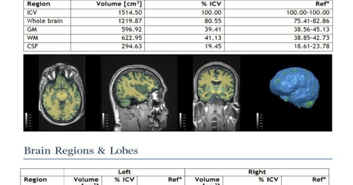 "뇌 MRI 15분이면 끝"…해외서 먼저 알아본 한국 의료AI[빠정예진]