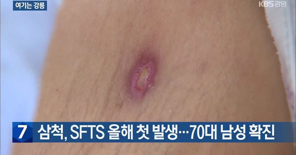 [여기는 강릉] 삼척, SFTS 올해 첫 발생…70대 남성 확진 외